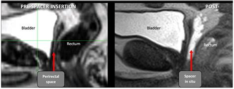 Rectal Spacer Reduces Gastrointestinal Side Effects Of Radiation Post