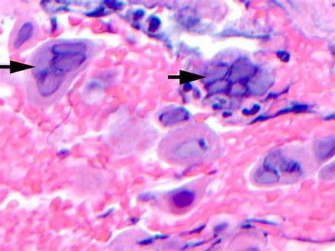 Herpes Simplex Dermatology Medbullets Step 23