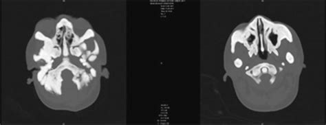 Suboccipital Craniectomy And C 1 Laminectomy Shown On Cranial Ct Images