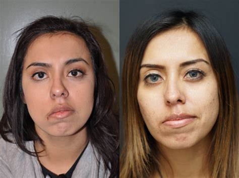 Case Presentation Facial Paralysis Pacific Head And Neck