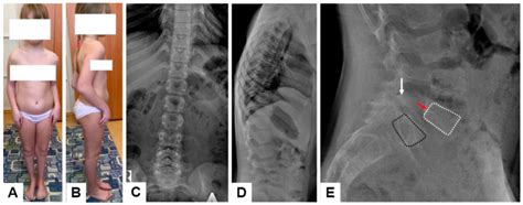 Presentation Of Rare Phenotypes Associated With The Fkbp10 Gene Pmc
