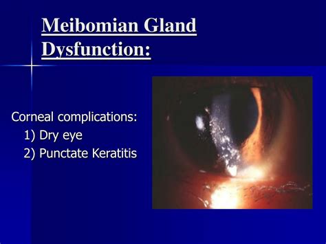 Ppt Posterior Blepharitis Powerpoint Presentation Free Download Id