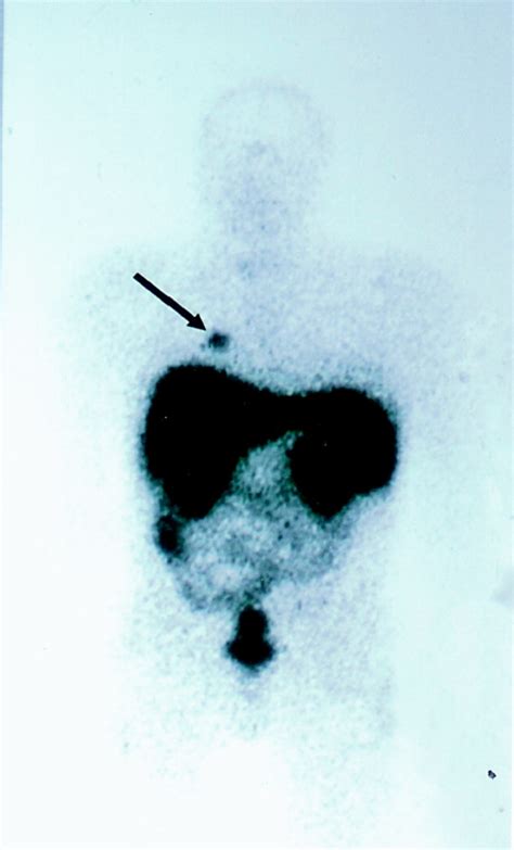 Octreotide Scan For Carcinoids Mdedge