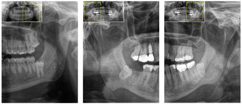 Imaging In Third Molar Surgery A Clinical Update