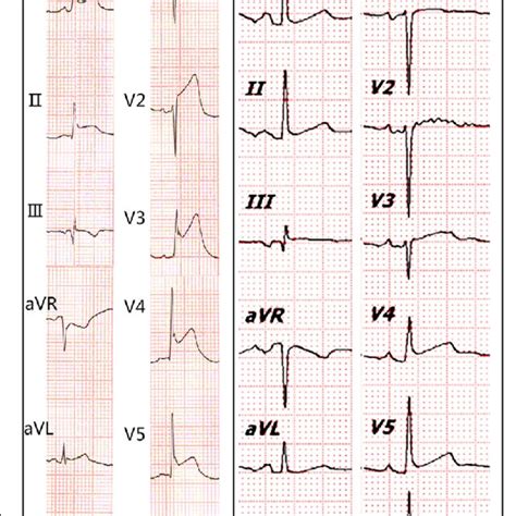 A Widespread Concave St Segment Elevation Was Present In