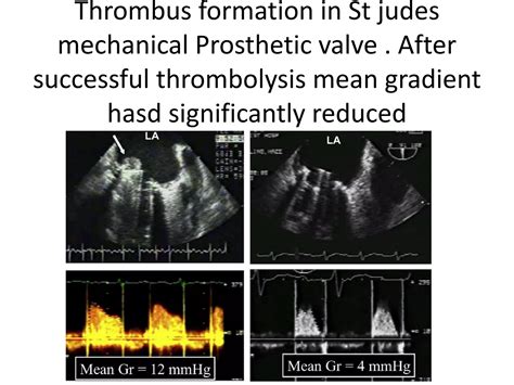 Echo In Prosthetic Valve Evaluation Pptx