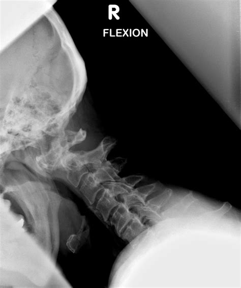 Normal Flexion Extension Cervical Spine X Rays Booysigns