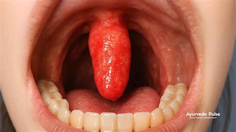 Ayurvedic Uvulitis Treatment Galashundika Case Study
