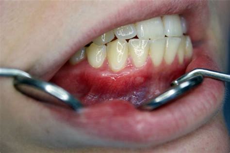 Result In 1 Month Complete Defect Coverage In The Area Of 43 Teeth