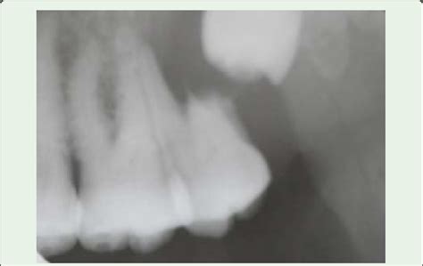 Root Resorption Of The Upper Left Second Molar Download Scientific