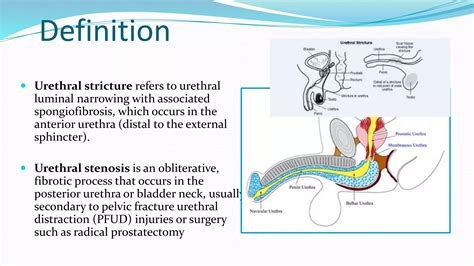 Urethroplasty Principles And Practicesspptx