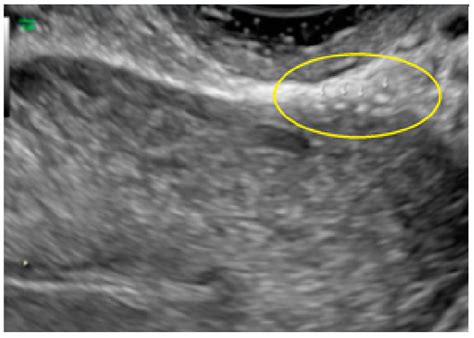 Rectouterine Pouch Ultrasound At William Ferdinand Blog