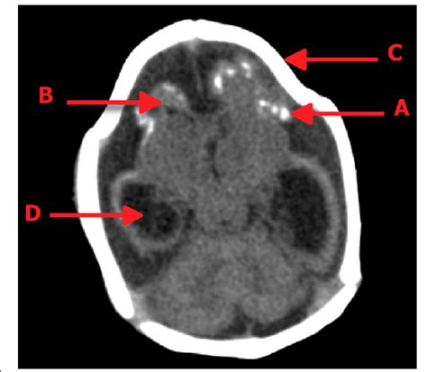 A Intracebral Calcifications Of The Congenital Prenatal Infectious