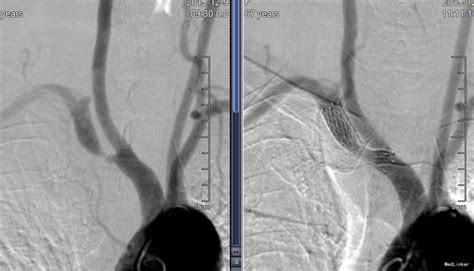 锁骨下动脉狭窄，盗血综合征1例 医联
