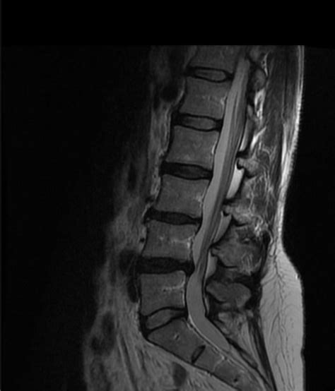 What Do The Rest Of The Mri Findings Mean Sciatica