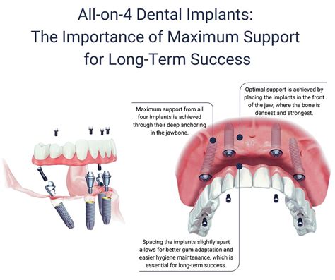 All On 4 Dental Implants Nyc Implant Dentures Midtown Manhattan And Ues