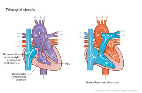 Cardiology Tricuspid Atresia