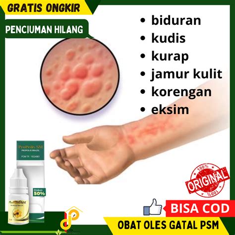 Badan Gatal Gatal Tanpa Sebab Jovanteallen