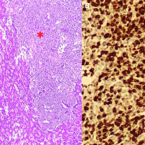 Grayscale Usg Axial Images A B Demonstrating A Large Hypoechoic Mass