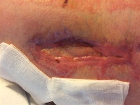 Post Surgical Pyoderma Granulosum Prevention Recognition And