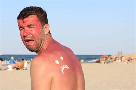 Preventing And Treating Sunburns