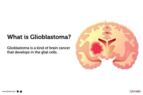 What Causes Glioblastoma Glioblastoma Overview Of Disease And