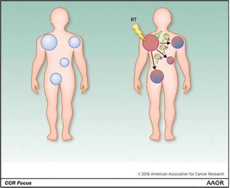 Investigating The Abscopal Effect As A Treatment For Cancer Nci