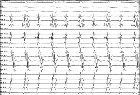 Atrial Tachycardia With 21 Av Block With An Atypical Right Atrial Download Scientific Diagram