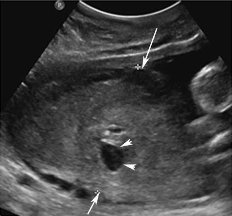 Placental Abruption And Hemorrhage—review Of Imaging Appearance