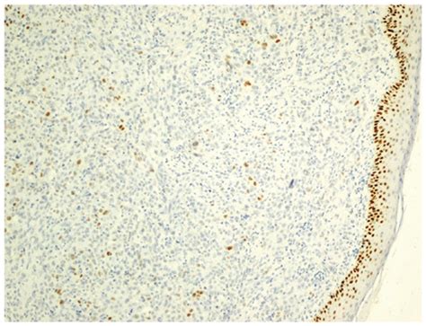 Immunohistochemical Staining Revealed Positivity For Focal P63 Stain