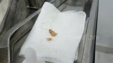 Vietnamese Doctor Extracts Large Cockroach From Womans Inner Ear Buy