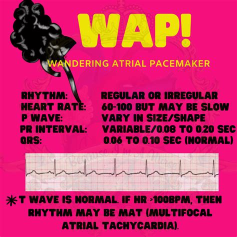 Wandering Atrial Pacemaker
