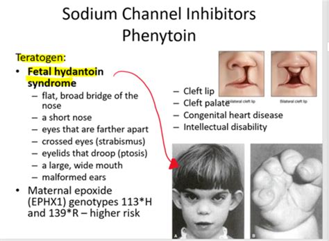 Fetal Hydantoin Syndrome Behavioural And Psychological Issues In Fetal
