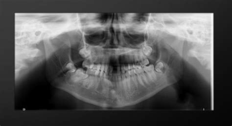 Panoramic Imaging Errors Flashcards Quizlet