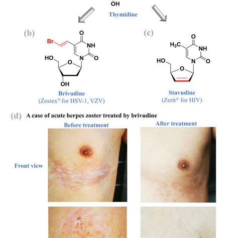 Thymidine And Thymidine Nucleoside Analogues Development From