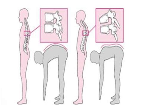 佝偻病儿童的典型图片有来医生
