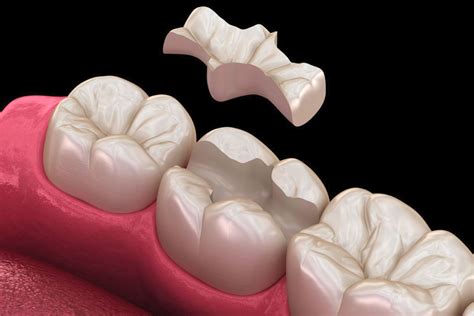 Inlays Onlays Richmond Dental Centre