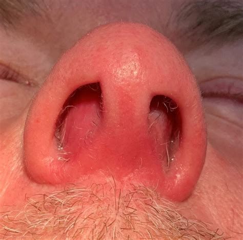 Nasal Septal Abscess Following Septoplasty In A Patient With Type 2