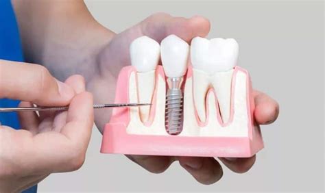 How Much Bone Is Required For Dental Implants
