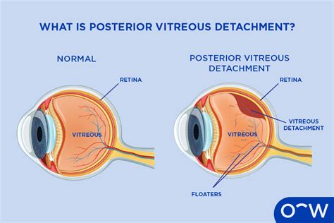 Posterior Vitreous Detachment Pvd Eye Causes Diagnosis And Treatments