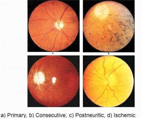 Optic Atrophy