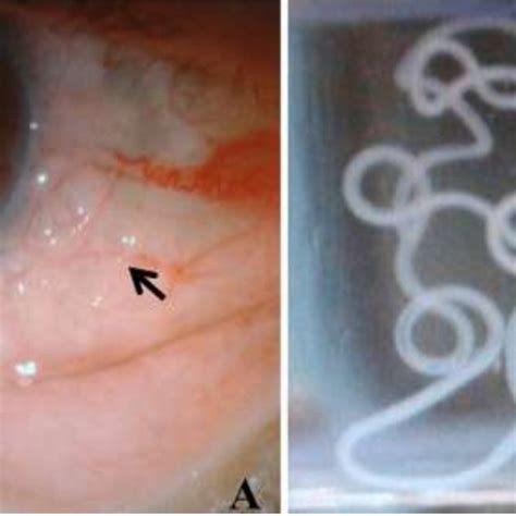 Panel A A Round Worm Moving In Subconjunctival Of Median Side Of Right