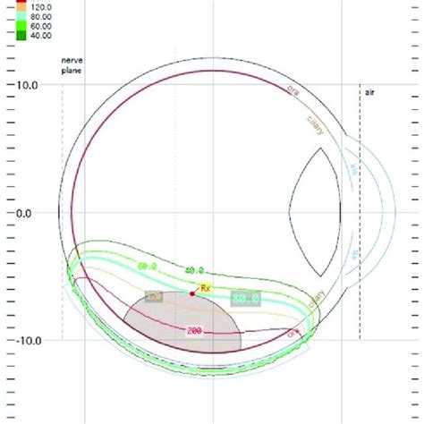 Ruthenium−106 Brachytherapy Planning System In Plaque Simulator
