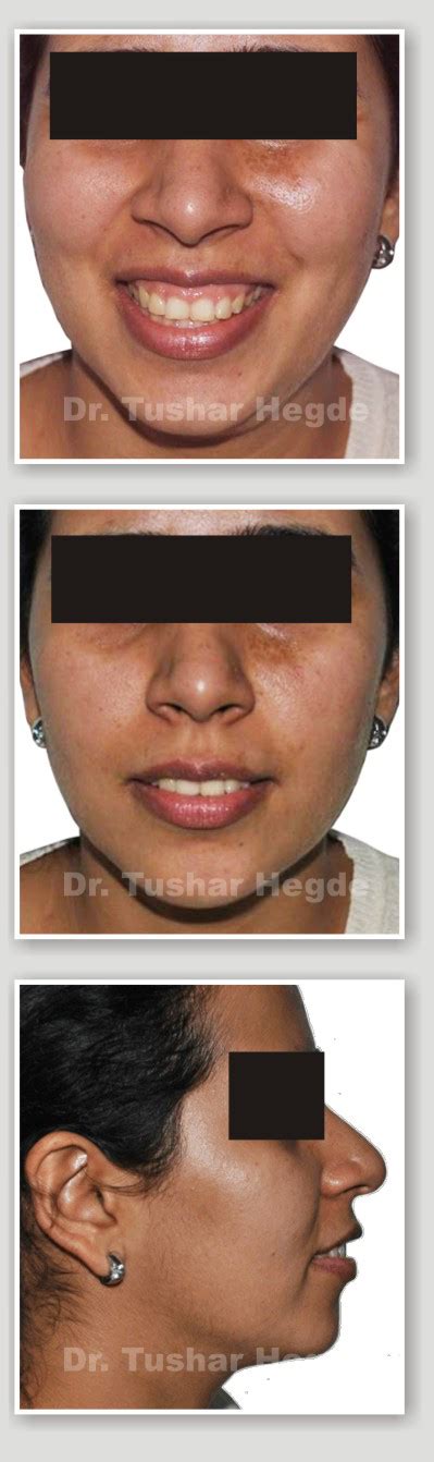 Dental Protrusion Smile With Braces