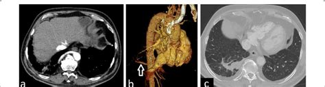 A 67 Year Old Asymptomatic Male With Sequestration Contrast Enhanced