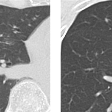 Shows A Transient Asymptomatic Pulmonary Opacities Pattern A