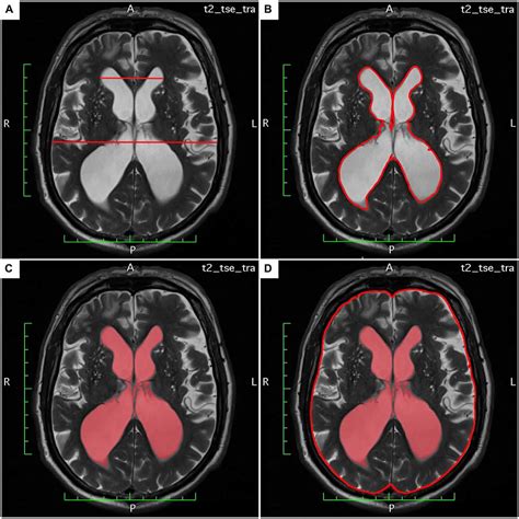 Enlarged Brain Ventricles Mri Chronic Alcohol Use Associated