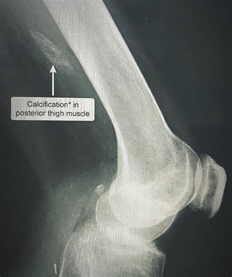 Myositis Ossificans Metaplastic Bone Formation Within Muscle Tissue R Radiology