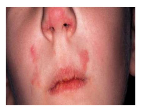 Dermatophyte Infection 2pptx Skin And Dermatology Diseases And
