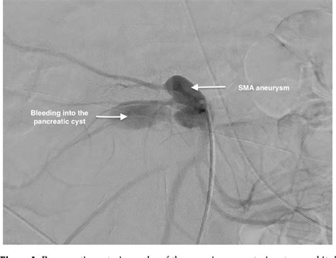Figure 3 From Management Of A Rare Case Of Superior Mesenteric Artery